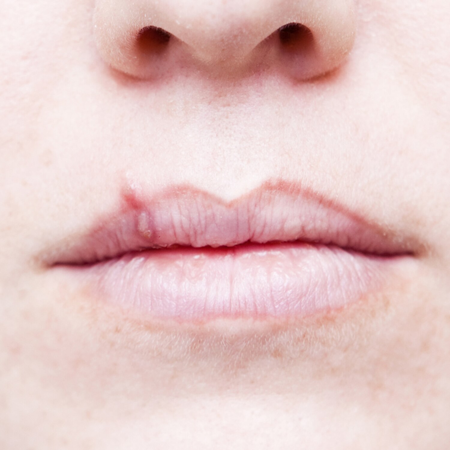 4 conseils pour traiter un feu sauvage naturellement | Coup de Pouce