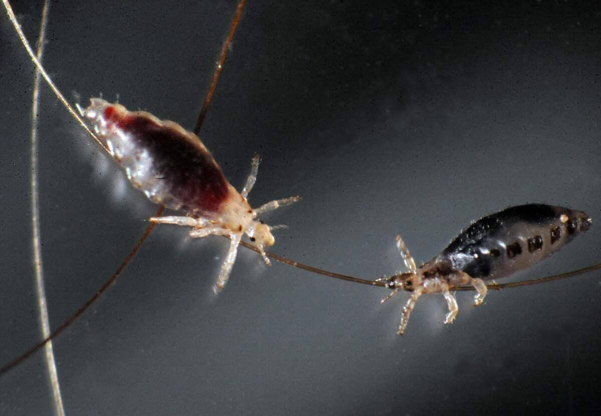 La mort d’une ado liée à son infestation de poux | TVA Nouvelles