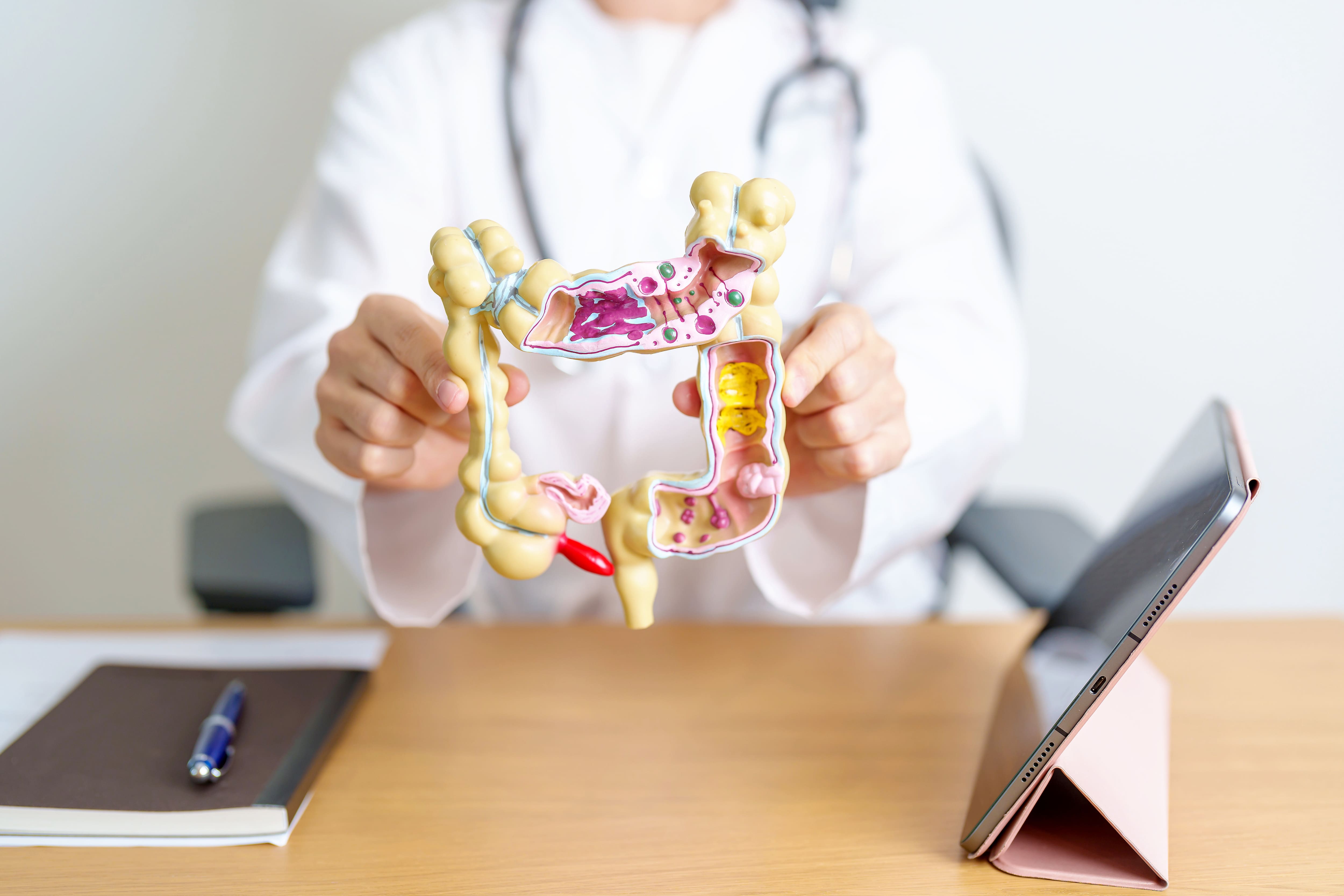 Colon Cancer Survival: Exercise Key to Better Outcomes – Archyde