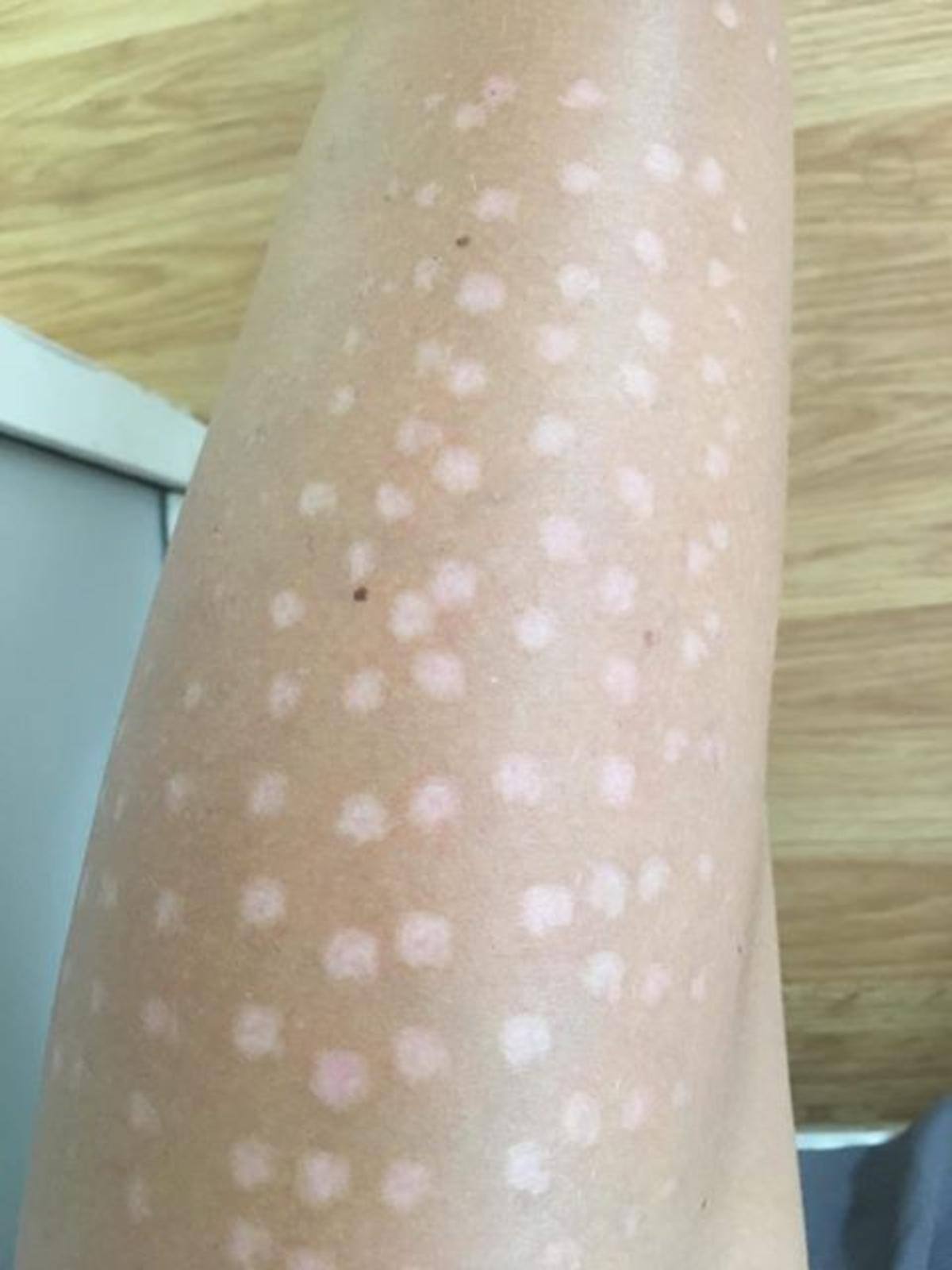 [PHOTOS] Une épilation au laser qui tourne au cauchemar | JDM