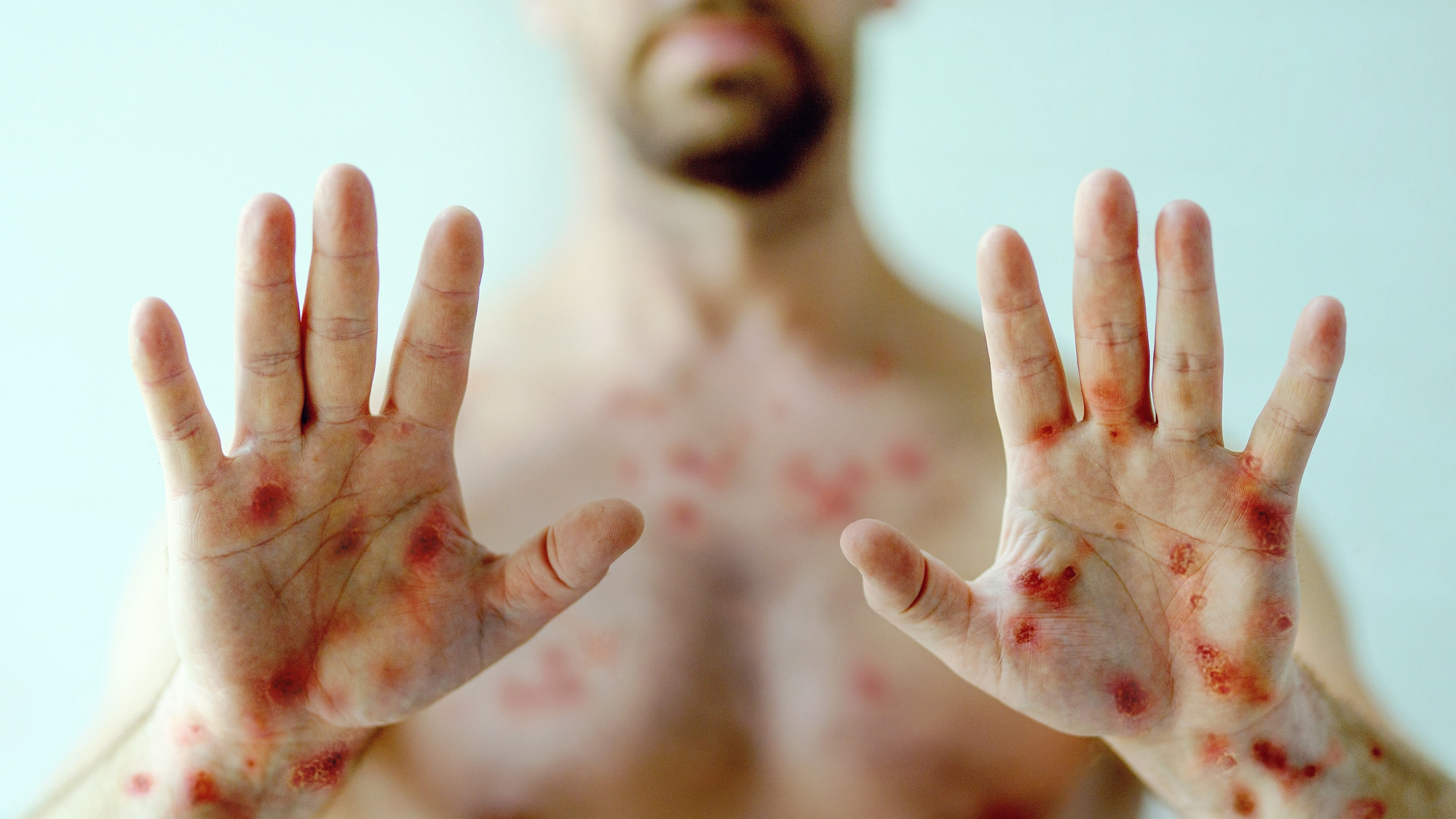 Variole simienne: tout savoir sur le virus de la mpox | TVA Nouvelles