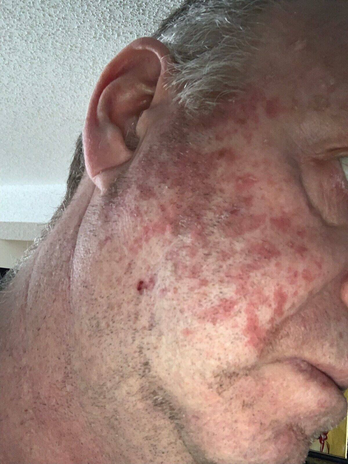The Dangers of Tanning: Actor's Battle with Skin Cancer Caused by UV ...