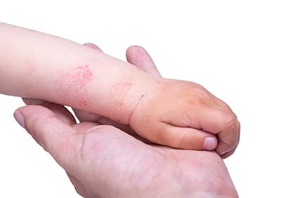 Boutons des bébés: comment les reconnaître et les soigner? | Coup de pouce