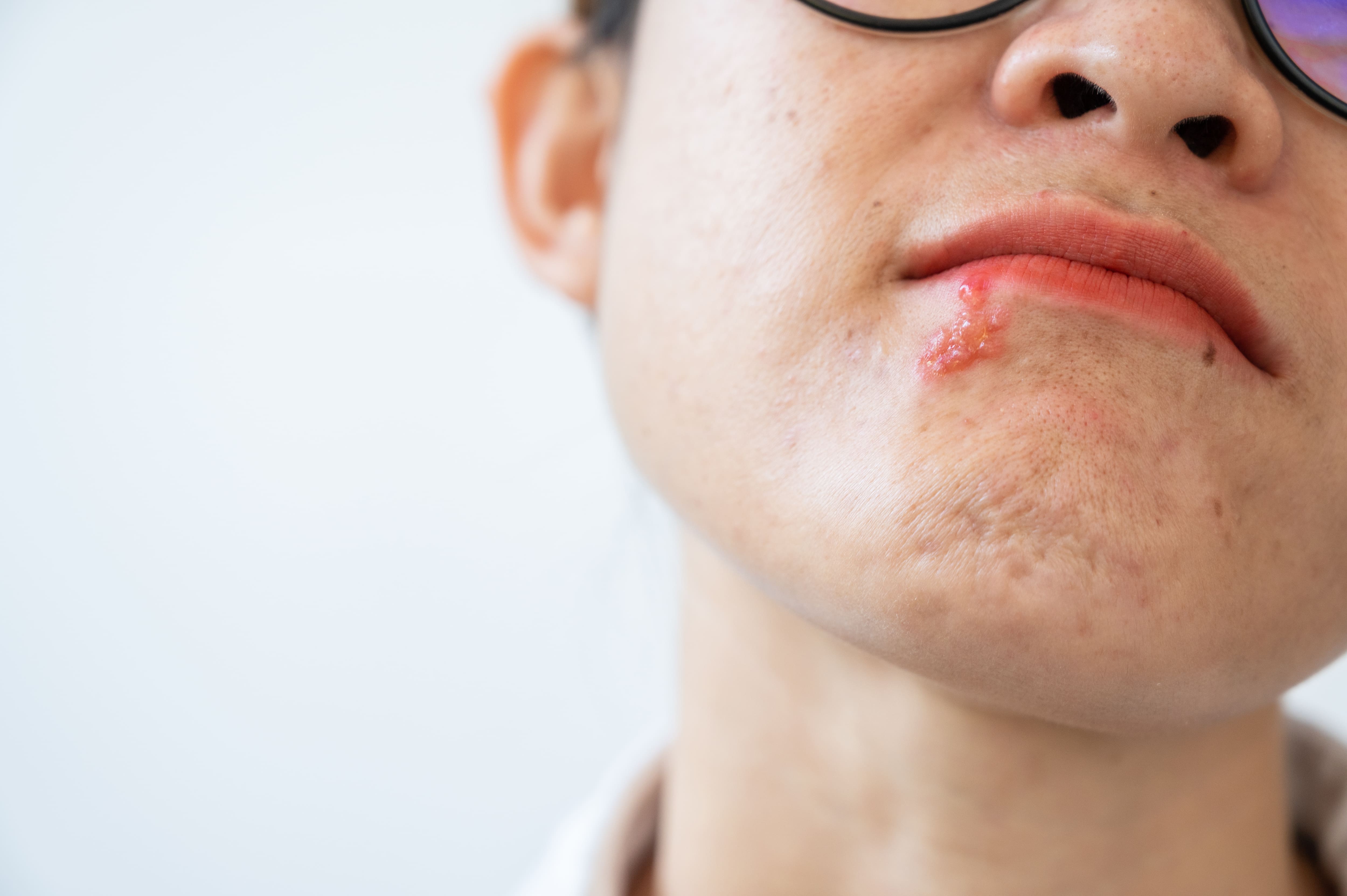 Attention aux feux sauvages: l’herpès buccal peut rester jusqu’à 1 ...