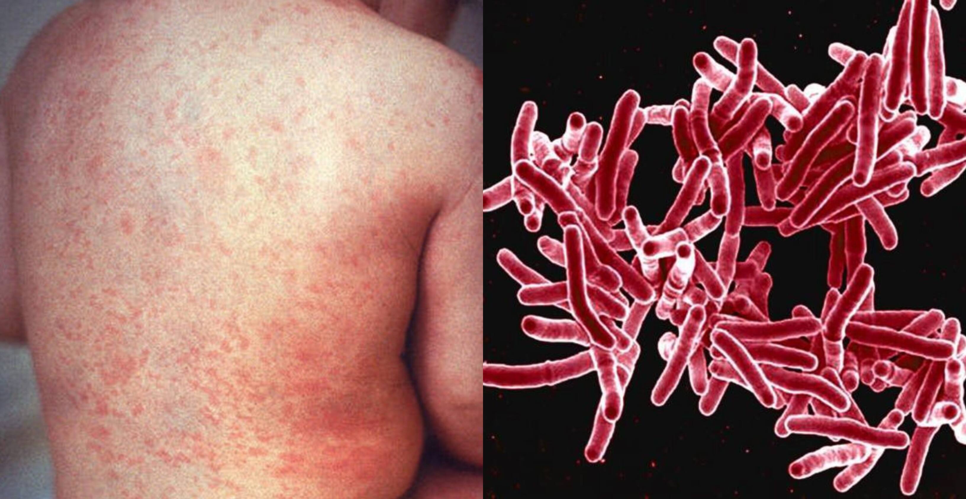 Voici 6 maladies (dont la rougeole) que l’on croyait disparues au ...