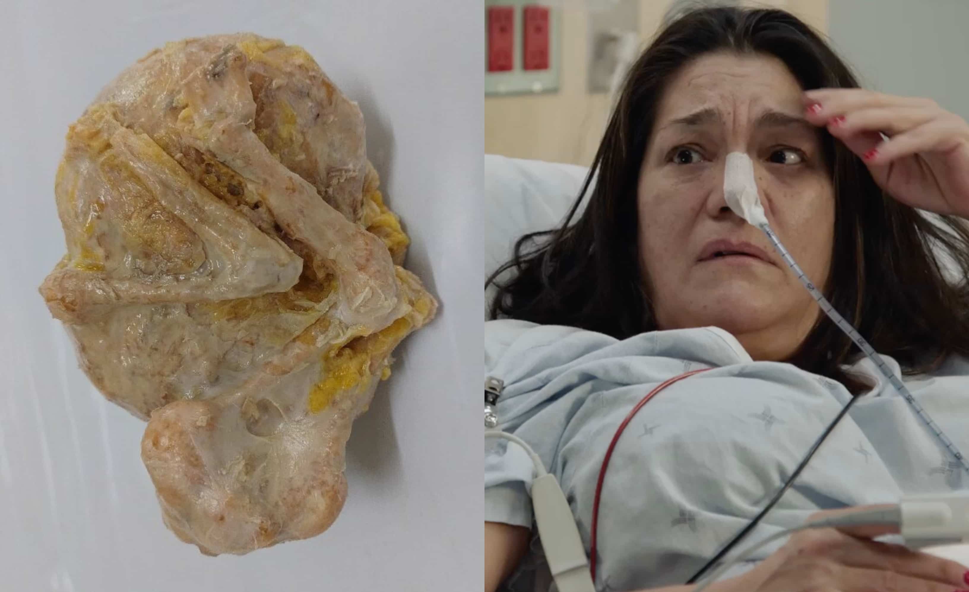 What is a calcified fetus discovered in a “STAT” patient? – Archyde