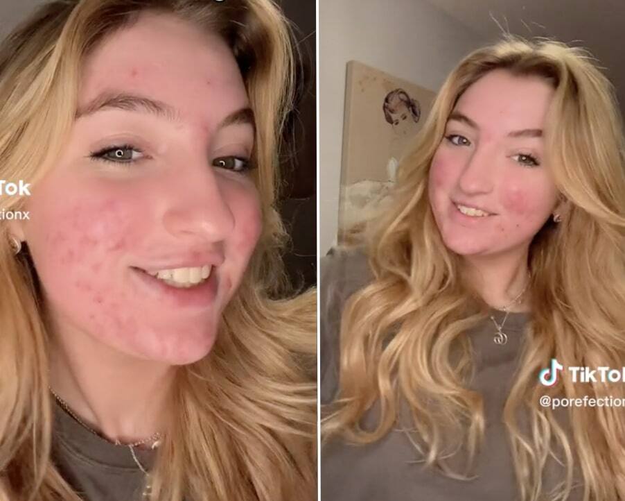 Une Tiktokeuse bannie de la plateforme car son acné est «difficile à ...
