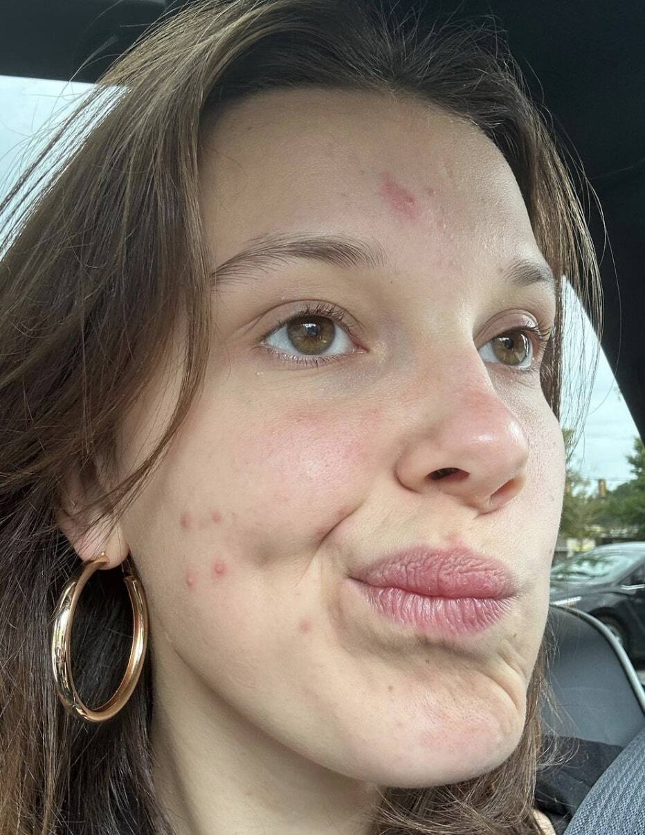 Millie Bobby Brown encensée pour avoir affiché son acné sans filtre sur Instagram | billie