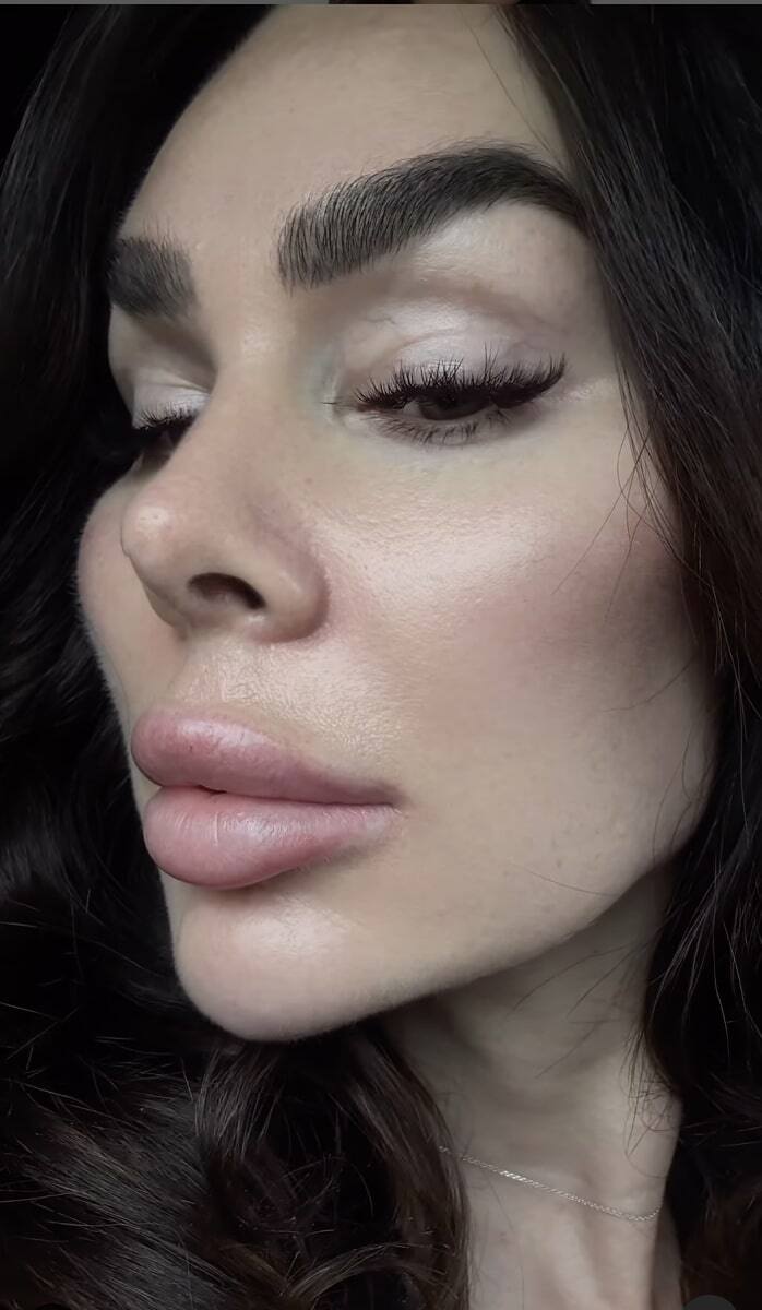 Gabrielle Marion fait dissoudre des «fillers» dans ses lèvres et montre ...