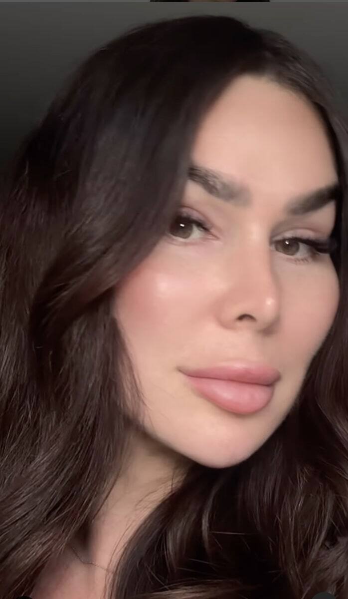 Gabrielle Marion fait dissoudre des «fillers» dans ses lèvres et montre ...