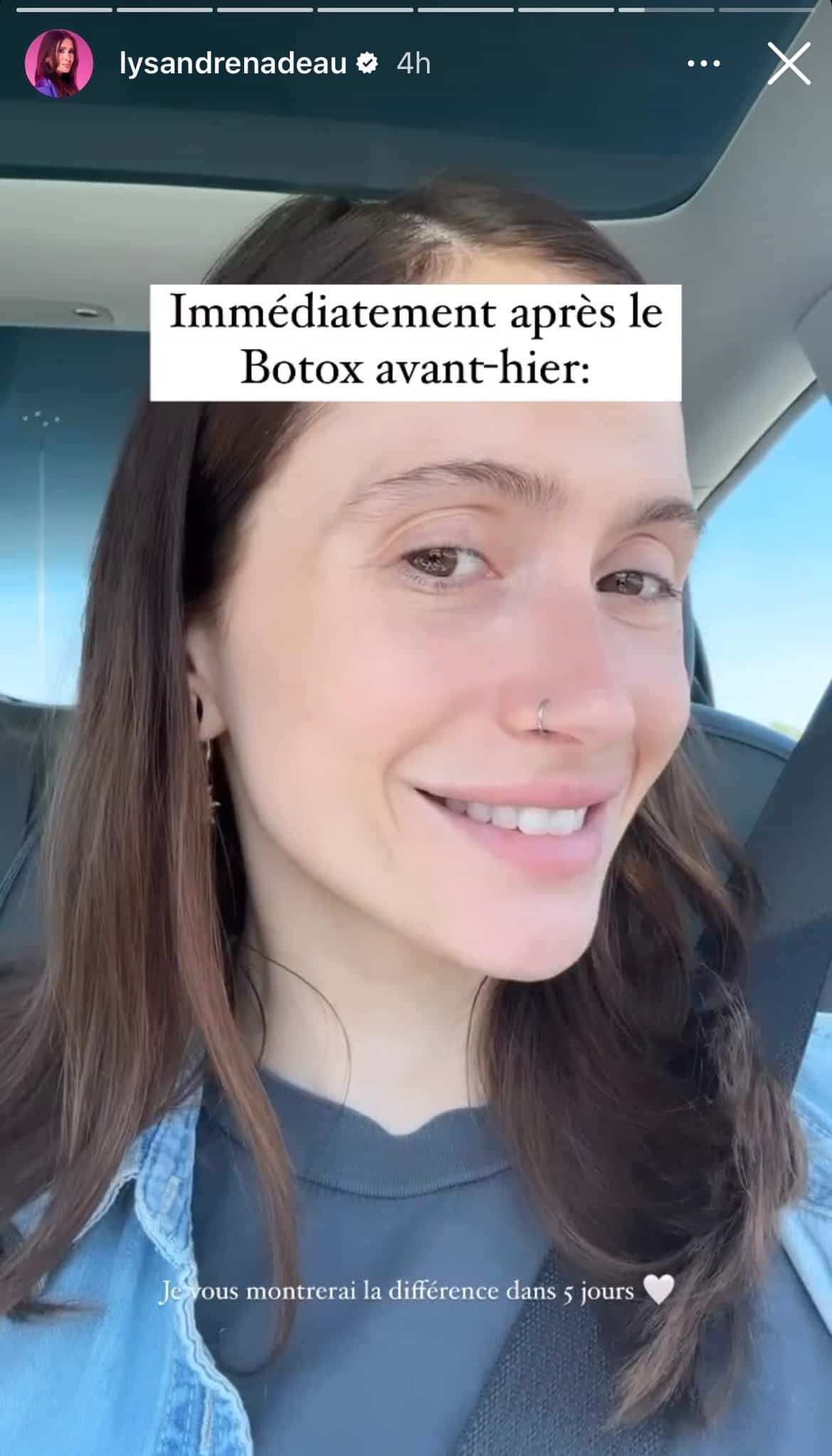 Lysandre Nadeau plus transparente que jamais sur ses nouvelles injections de botox | 24 heures