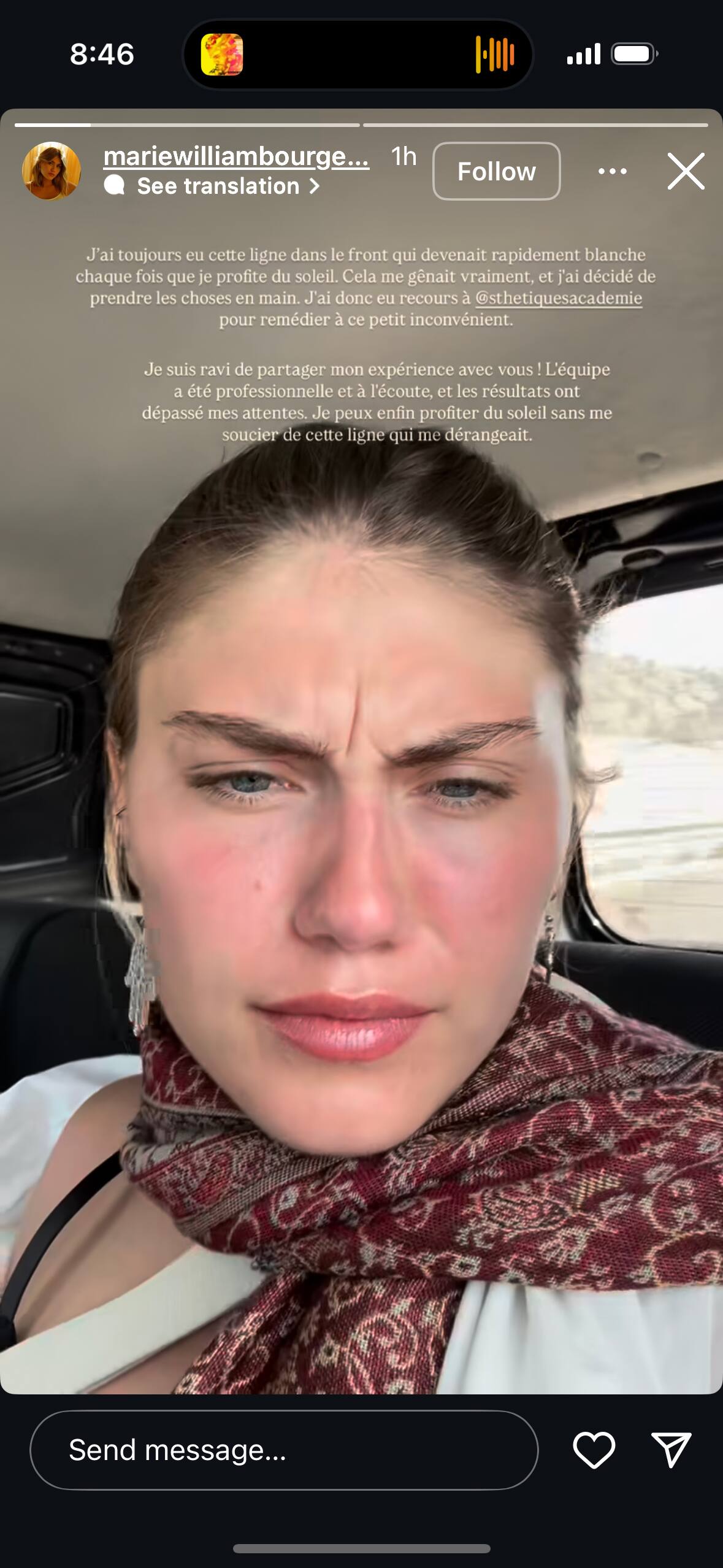 Marie-William Bourgeois se prononce sur son recours au Botox | billie