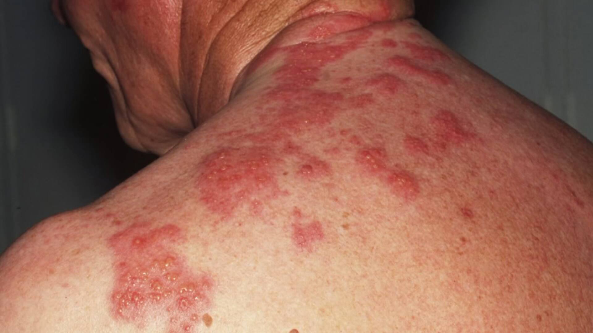 Shingles, painful and capricious disease - Archynewsy