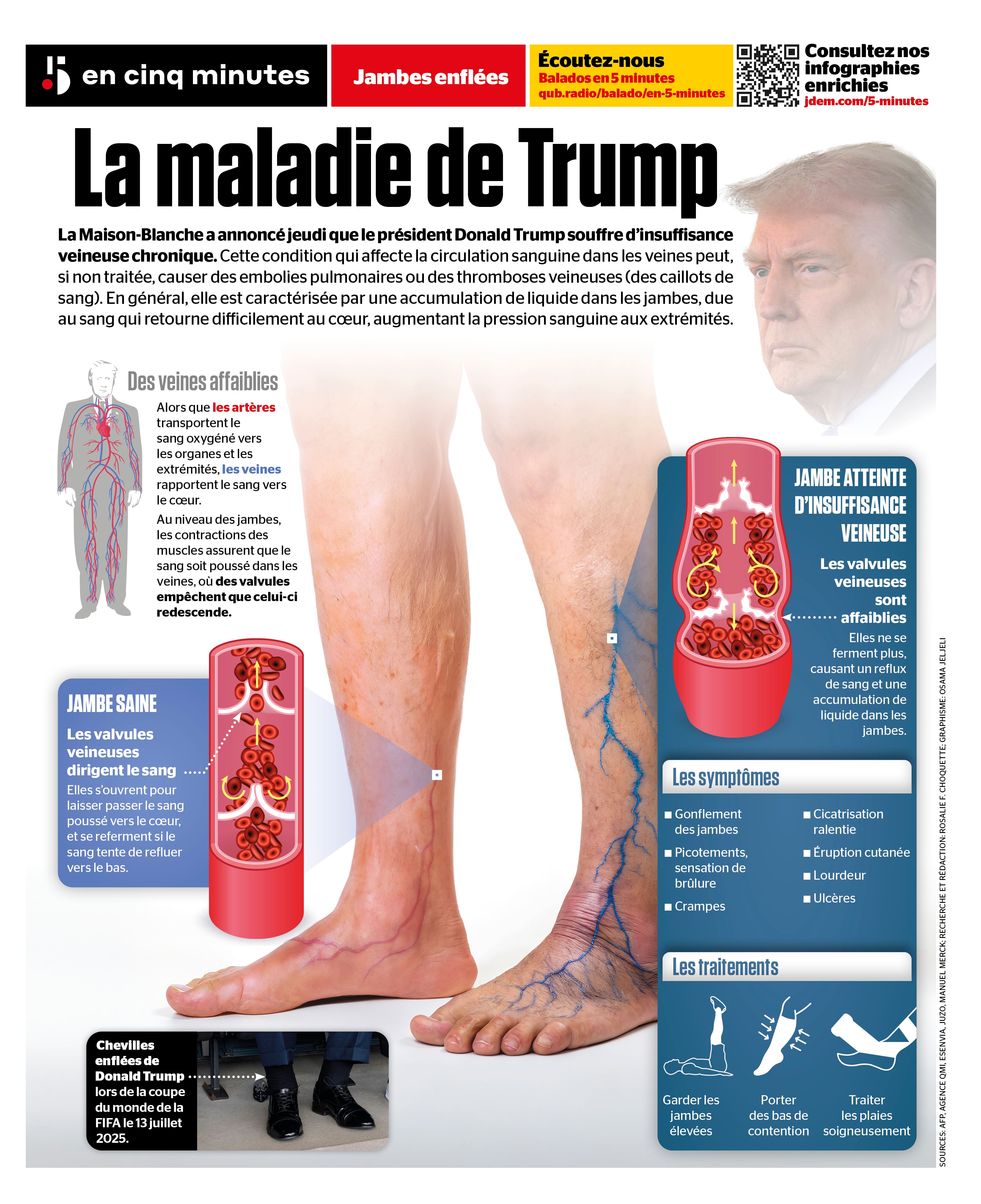 Insuffisance veineuse chronique: la maladie de Trump | JDQ