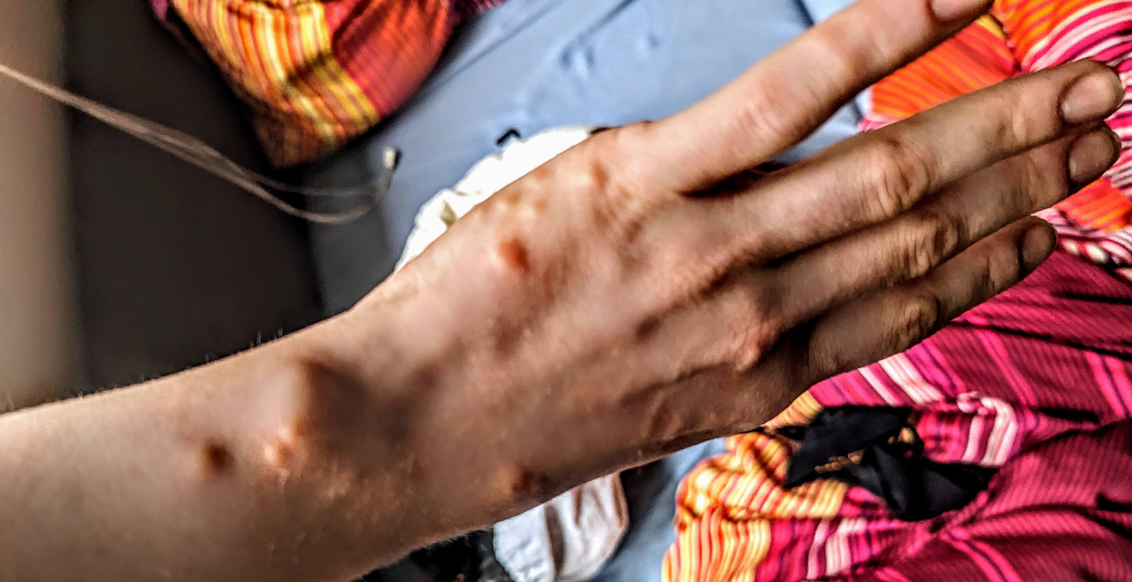 [PHOTOS] Airbnb infesté de punaises de lit à Montréal: couverte de ...