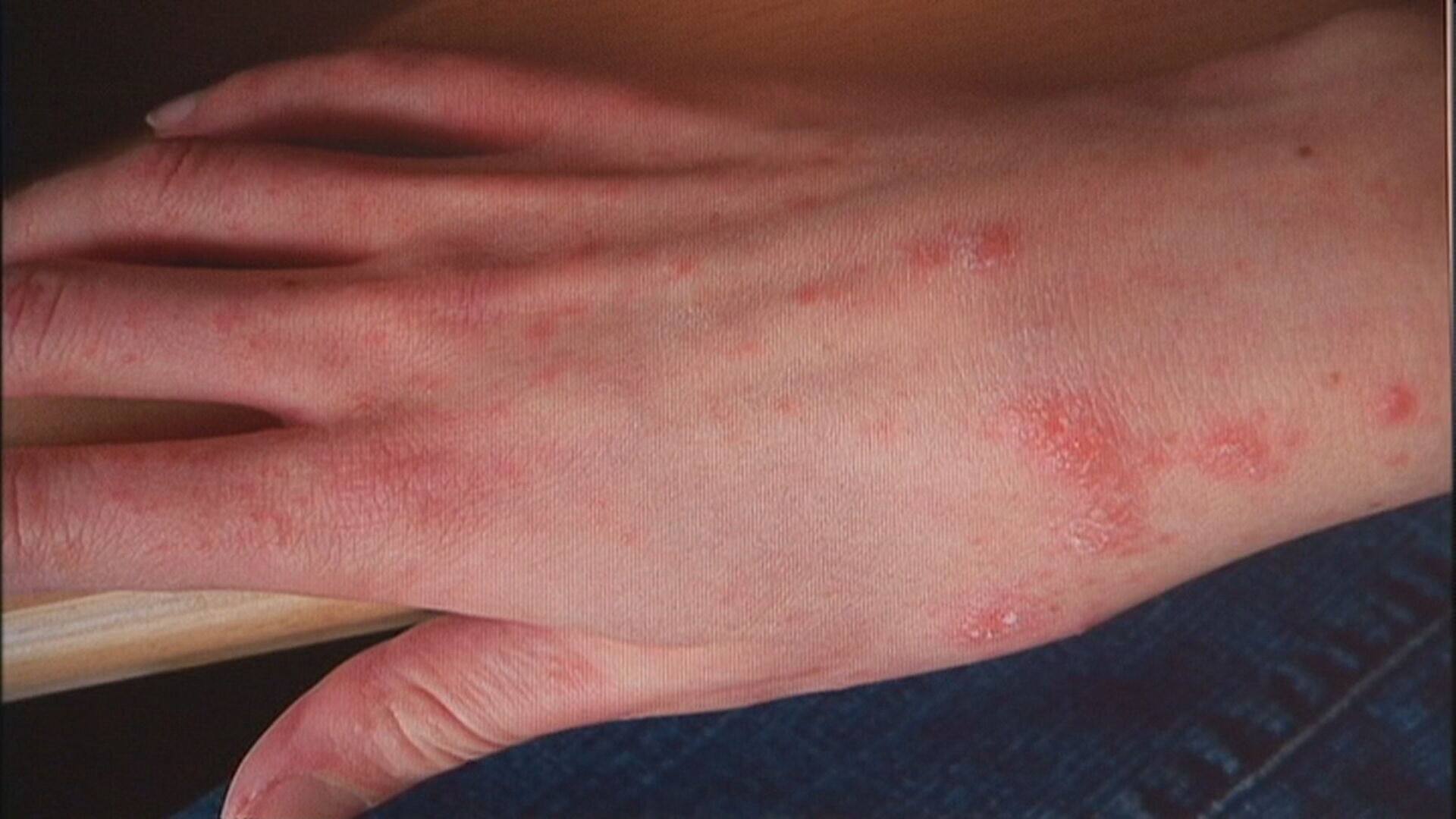 Plusieurs cas de gale dans une école secondaire de Trois-Rivières | TVA ...