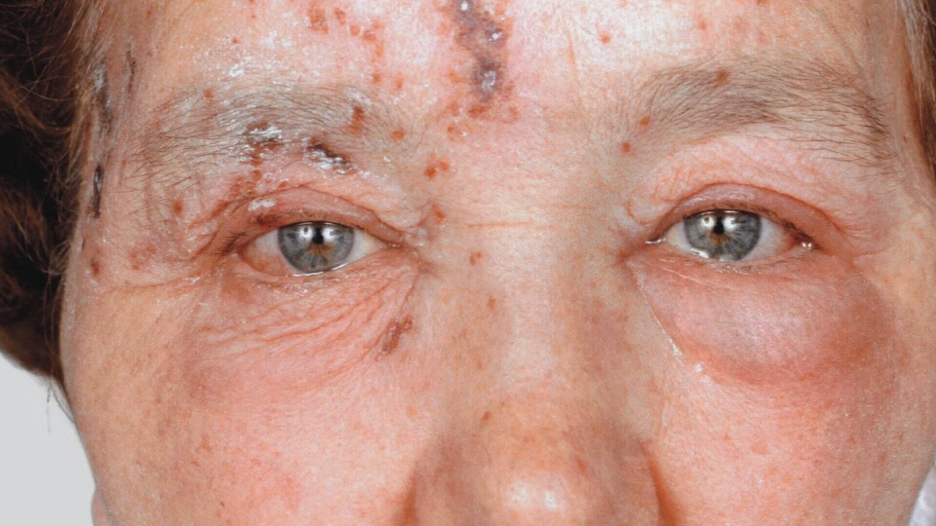 Êtes-vous protégé contre le zona? | Le Journal de Montréal