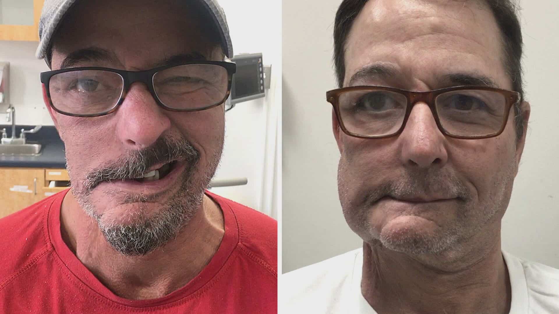 Une première réanimation de paralysie faciale au Québec grâce à une ...