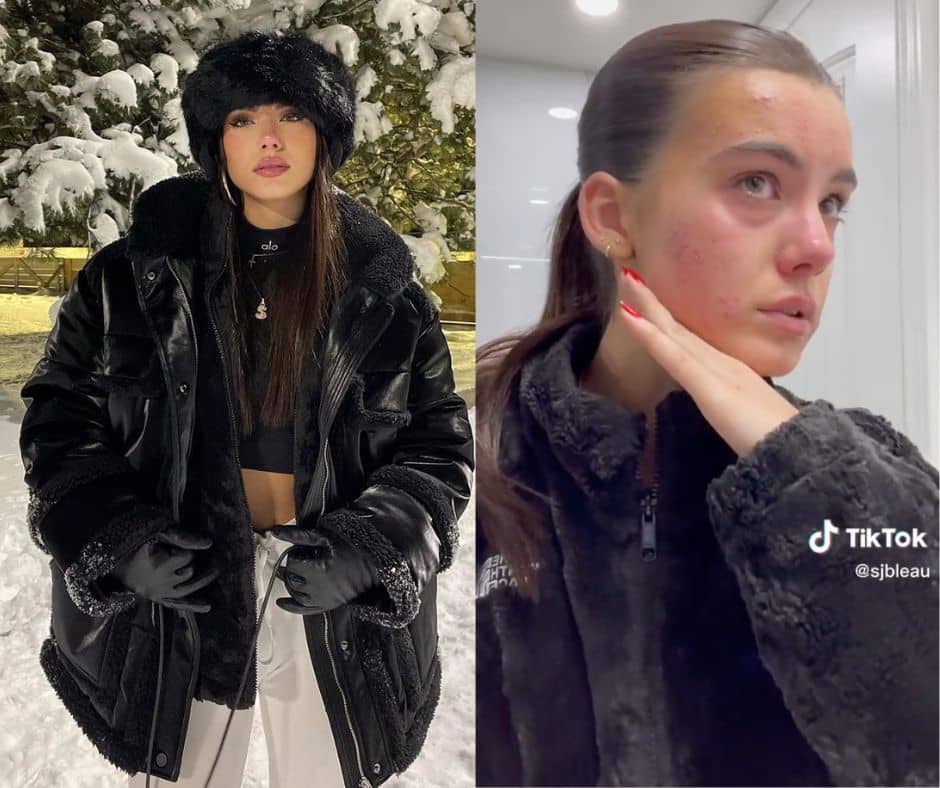 SJ Bleau fond en larme en se confiant sur son acné et son année ...