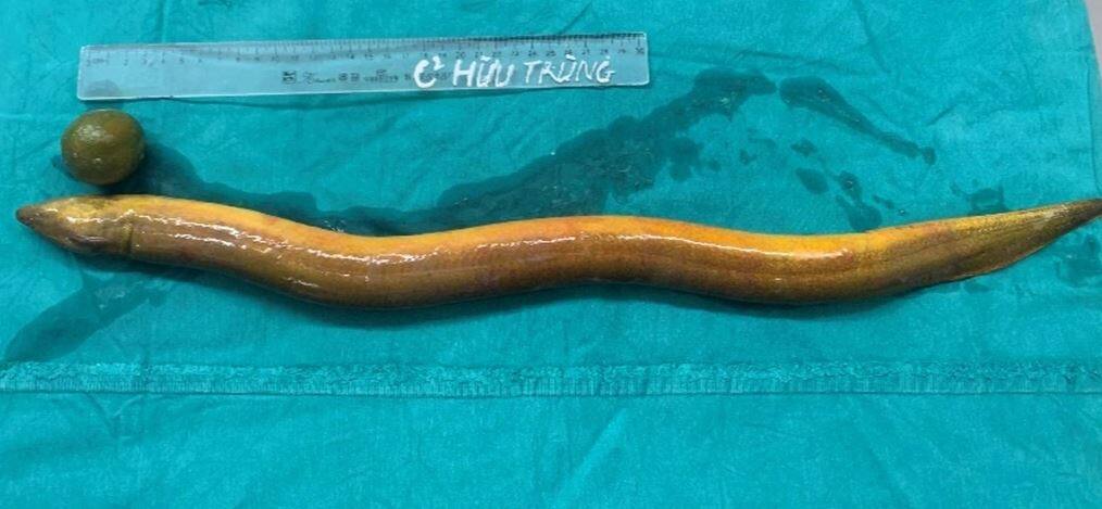 Un homme hospitalisé après s’être rentré une anguille vivante de 65 cm ...