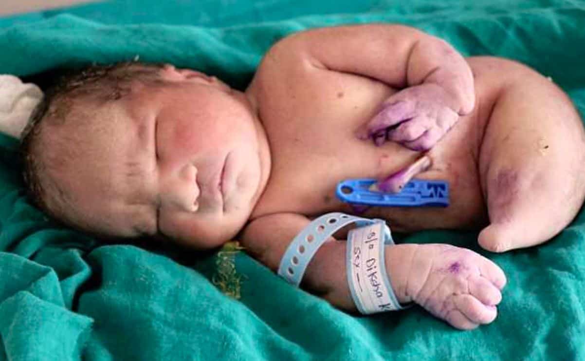 Une femme accouche d’un «bébé sirène» | JDQ