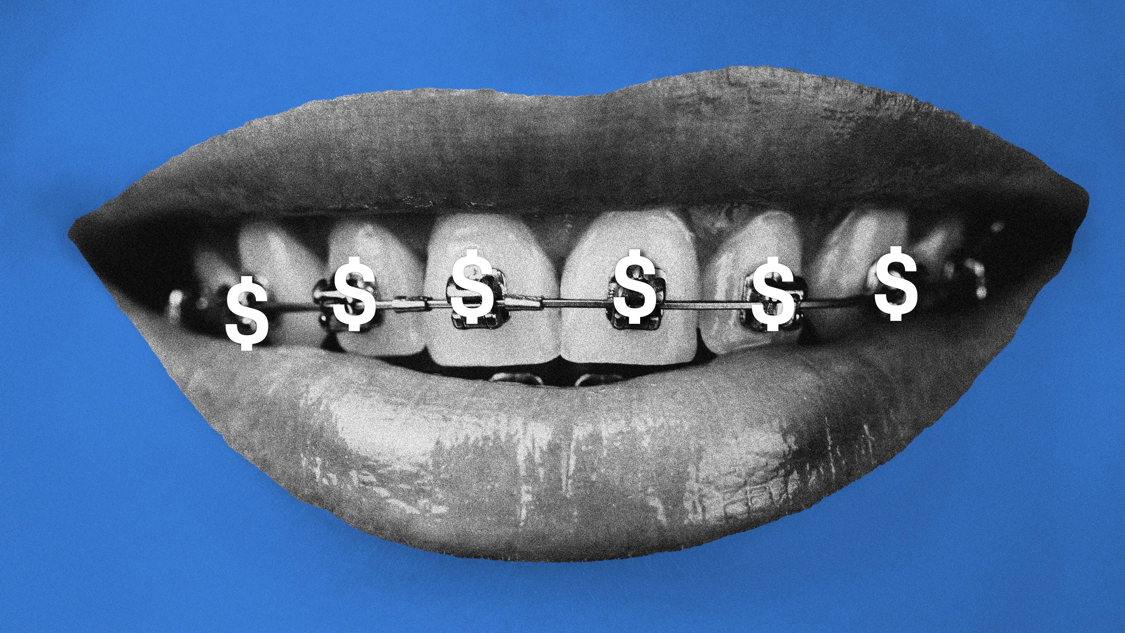 Combien ça coûte des broches au Québec? | 24 heures