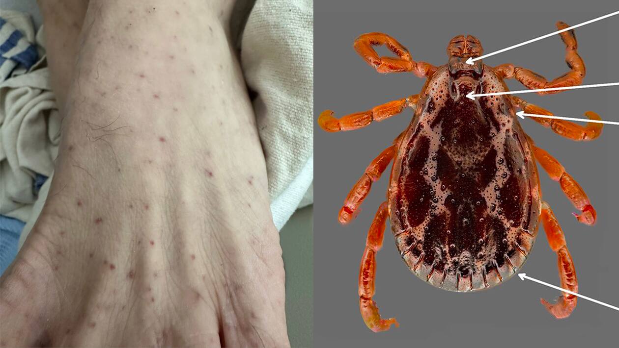 Premier cas au Québec: une nouvelle infection transmise par les tiques ...
