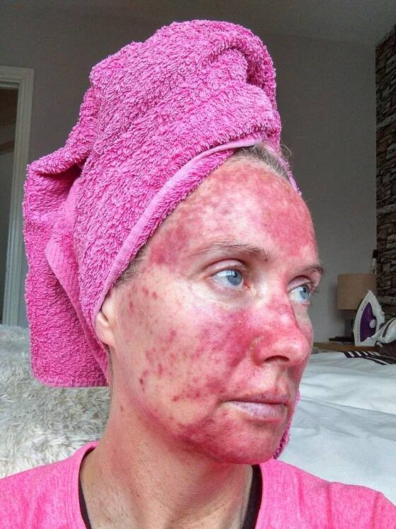 Cancer de la peau: voici les signes et symptômes à surveiller | 24 heures