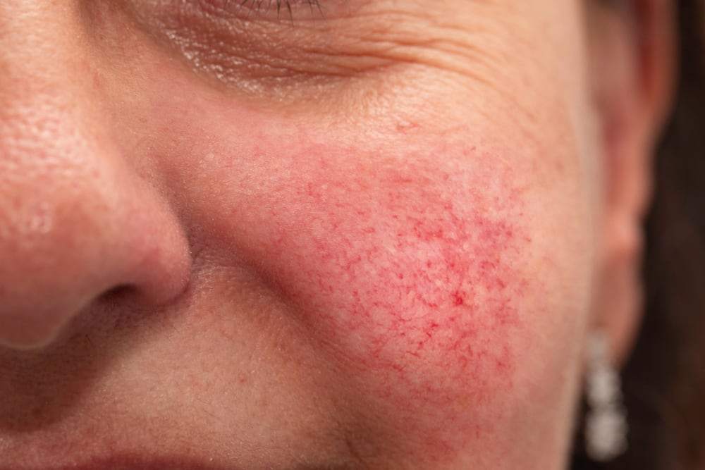 Causes et solutions pour 10 types de plaques rouges sur la peau | Salut ...