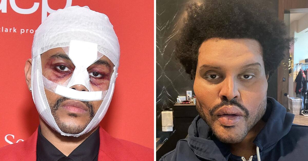 The Weeknd explique pourquoi il s’était couvert le visage de bandages ...